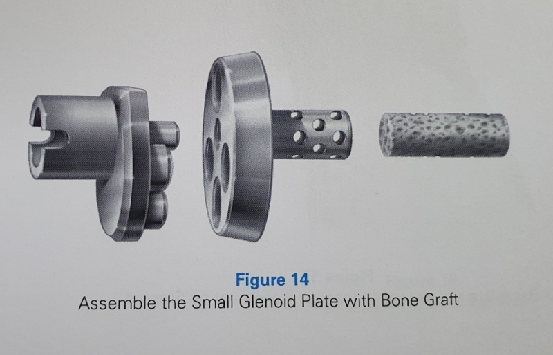 RTSA (exactech equinoxe) Dr.N : 네이버 블로그
