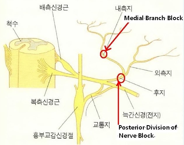 허리통증 - 허리디스크 - 신경차단술 (후지내측지차단술) - 근본정형외과 - 광장동정형외과 - MBB (Medial Branch ...