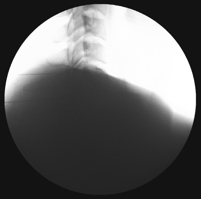 목 통증 - 목디스크 - 경추내측후지차단술 (Cervical MBB) - 구의동 근본 정형외과 : 네이버 블로그