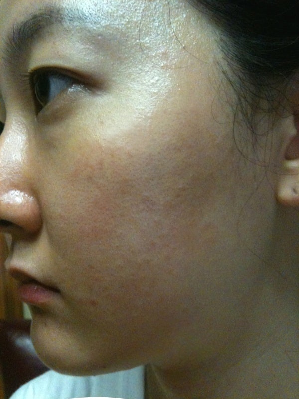 여드름 치료제 이소티논 1년 리얼 복용 후기 명현현상과 부작용 주의사항 그리고 효과후기 사진 있음 네이버 블로그