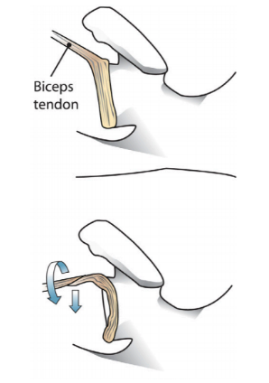 SLAP(Shoulder Superior Labrum Anterior to Posterior) Lesion - 어깨 상부 관절 ...