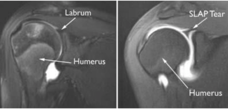 SLAP(Shoulder Superior Labrum Anterior to Posterior) Lesion - 어깨 상부 관절 ...