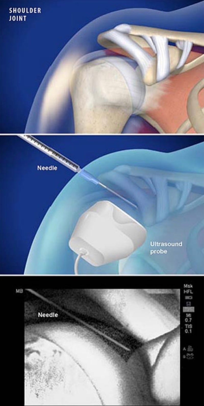SLAP(Shoulder Superior Labrum Anterior to Posterior) Lesion - 어깨 상부 관절 ...