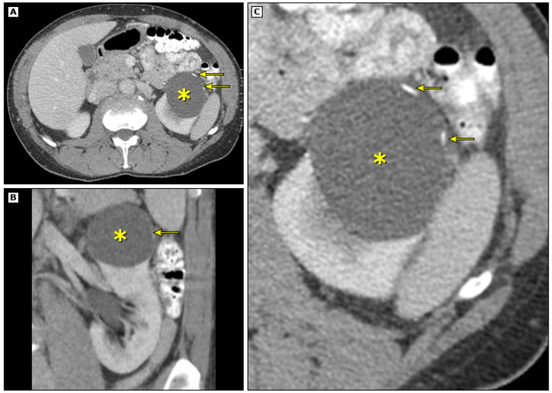 Bosniak classification of renal cysts : 네이버 블로그