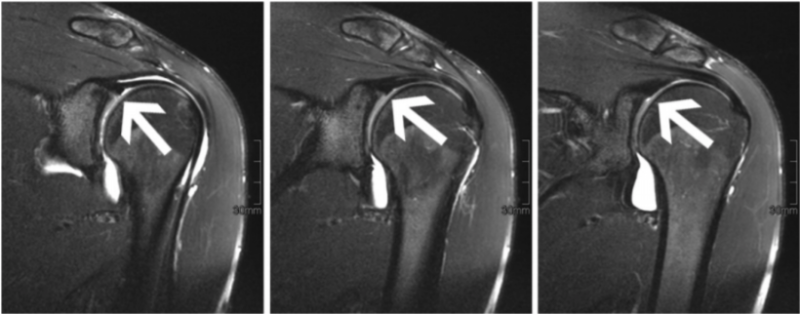 SLAP(Shoulder Superior Labrum Anterior to Posterior) Lesion - 어깨 상부 관절 ...