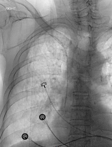 Central Venous Catheter(CVC, 중심정맥관, 중심정맥관 삽입술) : 네이버 블로그