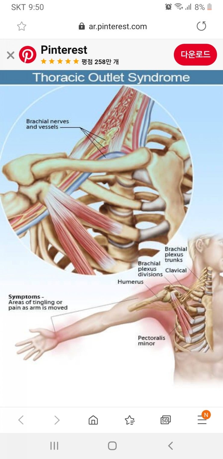 흉곽출구증후근 Thoracic Outlet Syndrometos 어깨아플때 어깨통증 팔저림 손저림 손목통증 네번째