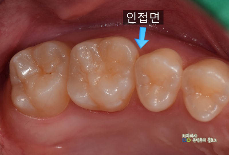 치아 홈메우기 보험적용 가능한 충치예방법 뭐가 있을까요 네이버 블로그