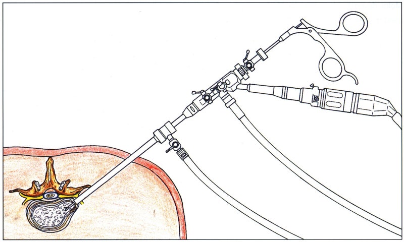 경피적 내시경 추간판제거술(PELD) : 네이버 블로그