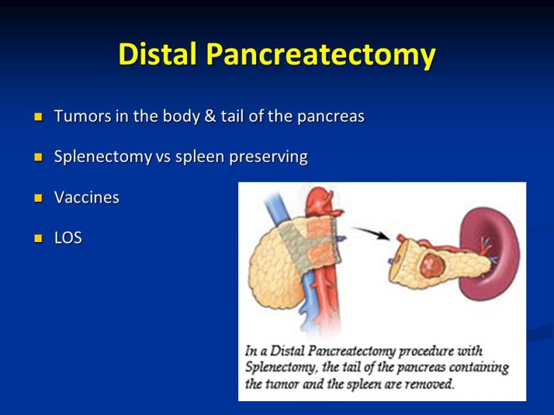 췌장암 수술의 종류와 유형(Surgery for Pancreatic Cancer) : 네이버 블로그