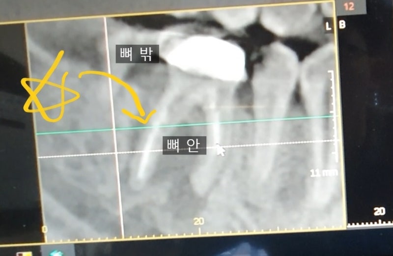 어금니 통증 1 신경치료 한 치아가 씹을 때 통증 있어요 2편 네이버 블로그