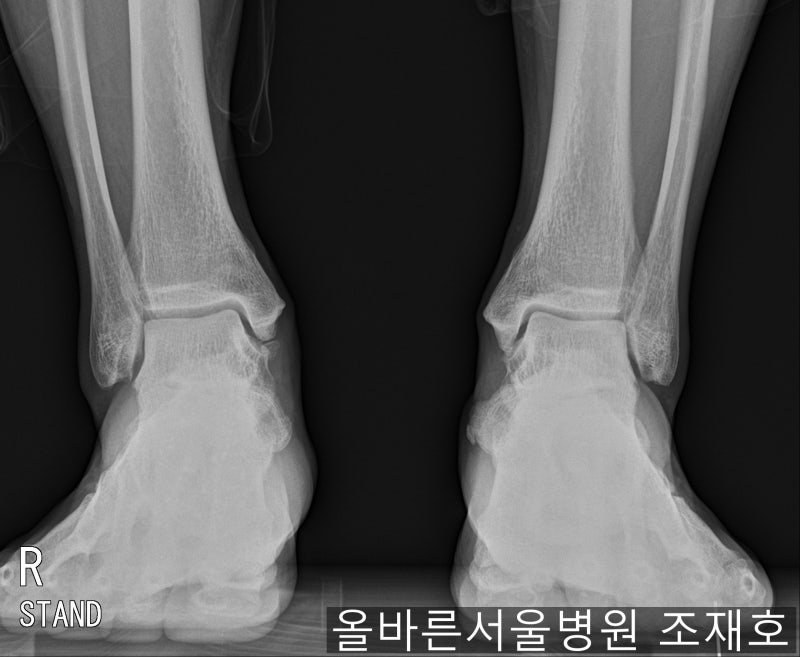 발목의 하글런드 병변(Haglund`s disease)에서의 관절경적 하글런드 병변 절제술 / 올바른서울병원 조재호 : 네이버 블로그