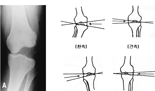 Pan의학자료무릎인대 파열과 장해진단 기준정형외과 기초이론12 네이버 블로그