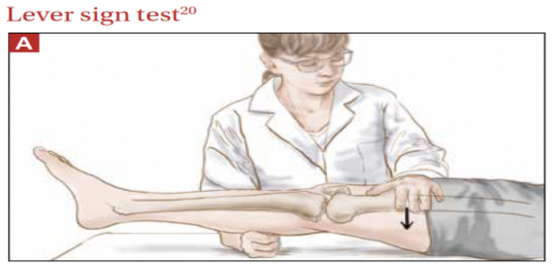 ACL : Anterior Cruciate Ligament tear(전방십자인대 파열) : 네이버 블로그