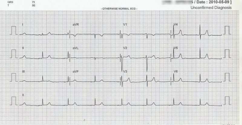 변이형협심증, 심전도, Variant angina, ECG : 네이버 블로그