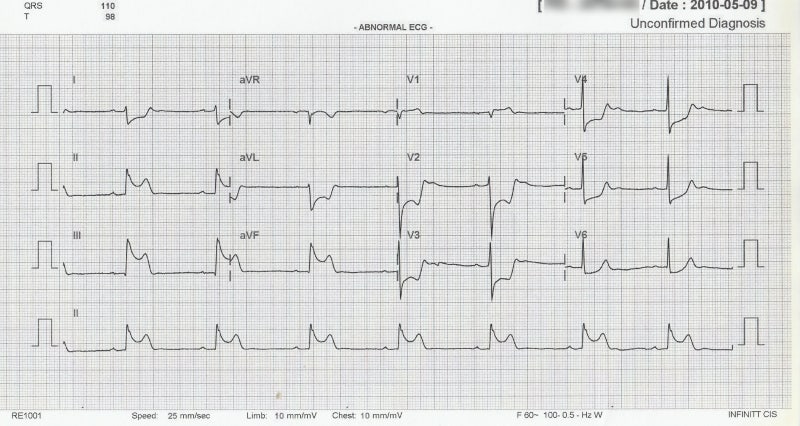 변이형협심증, 심전도, Variant angina, ECG : 네이버 블로그