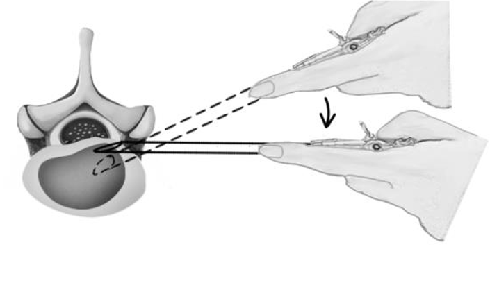 척추 내시경 (PELD, PSLD, 양방향 척추 내시경) : 네이버 블로그