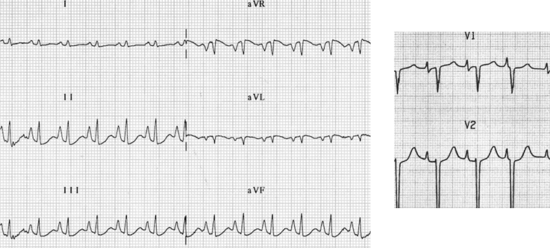 우심방 확장right Atrial Enlargement Rae 심전도ecg 기전과 특징 네이버 블로그