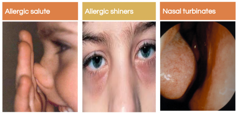 2. 알레르기성 비염 : 네이버 블로그