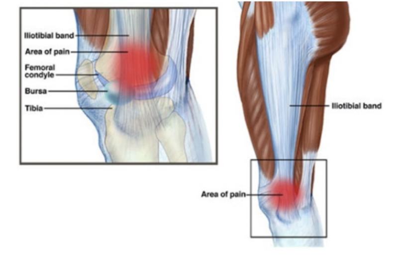 IT band Syndrome(장경인대증후군) : 네이버 블로그