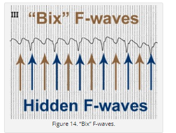 Bix rule, atrial flutter : 네이버 블로그