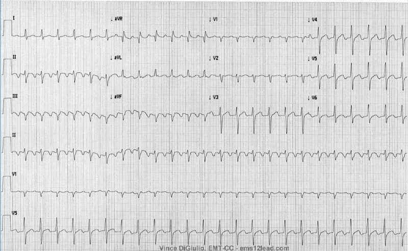 Bix rule, atrial flutter : 네이버 블로그