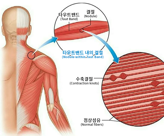 근육의 긴장띠, 스트레스 근육 '타우트밴드'(Taut band) : 네이버 블로그