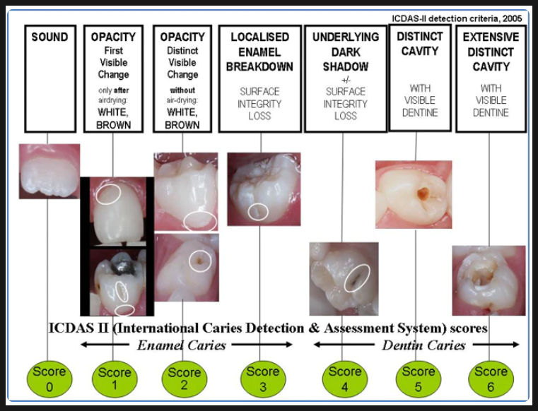 ICDAS 국제 충치 분류 기준 치대생/ 일반 덕후 : 네이버 블로그