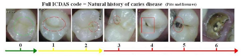 ICDAS 국제 충치 분류 기준 치대생/ 일반 덕후 : 네이버 블로그
