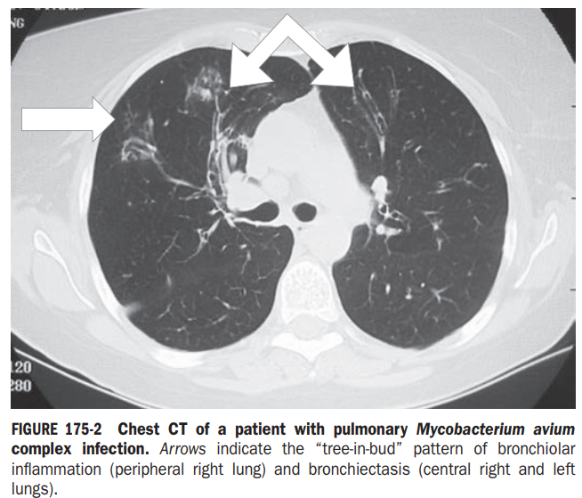 Pulmonary NTM (nontuberculous mycobacteria) : 네이버 블로그