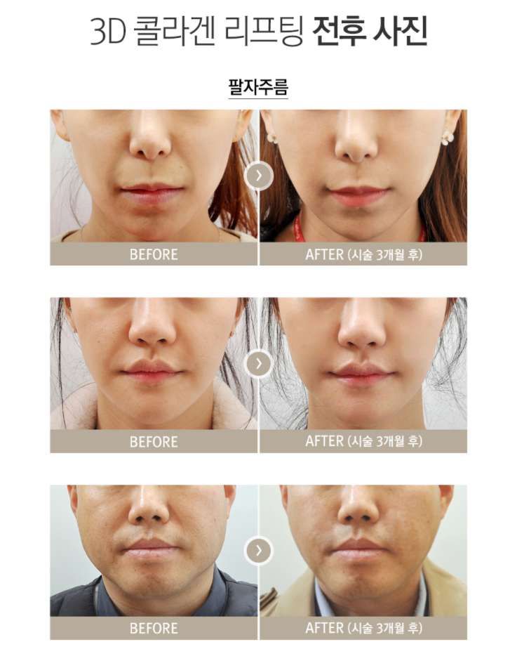 팔자주름없애기 완벽 솔루션 3d콜라겐 캐번리프팅팔자필러→팔자주름캐번리프팅 네이버 블로그