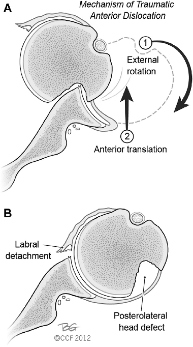 Hill-Sachs lesion(힐삭스 병변) : 네이버 블로그