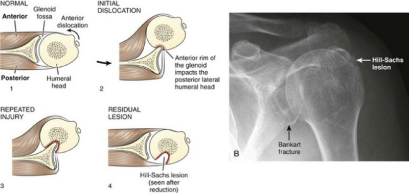 Hill-Sachs lesion(힐삭스 병변) : 네이버 블로그