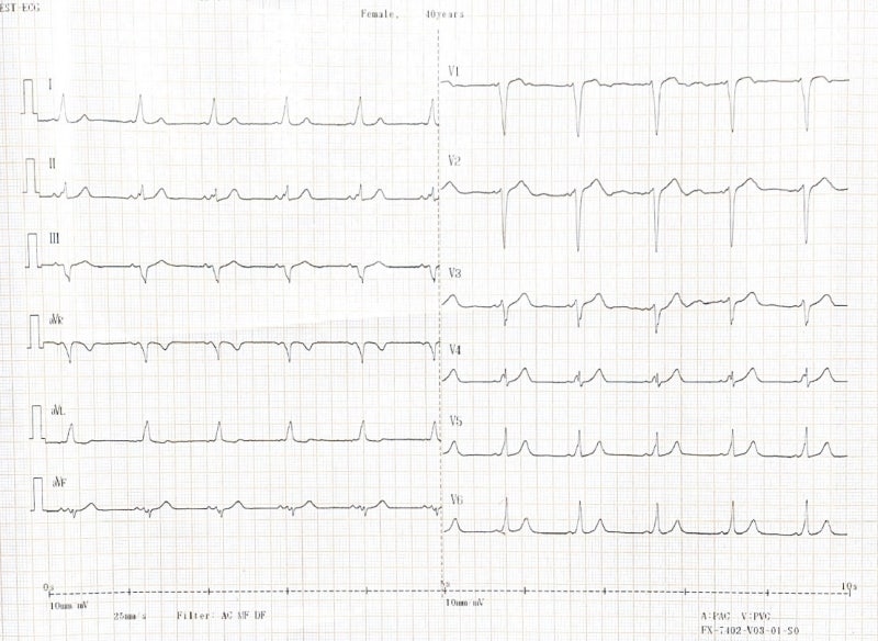 WPW 증후군 (Wolff-Parkinson-White syndrome) 환자의 심전도와 심초음파 : 네이버 블로그