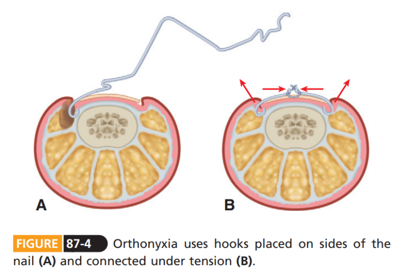 발가락이 아프고 옆에 고름이 나오고 ... 내성발톱! : 네이버 블로그