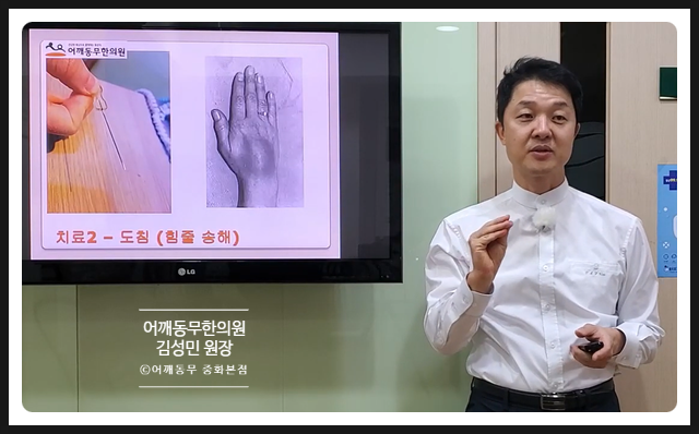 외상 후 부종증후군 (Secretan's syndrome / 다치고 나서 손등 붓기가 안 빠져요) : 네이버 블로그