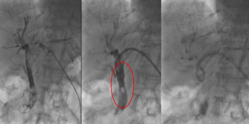 PTBD(Percutaneous Transhepatic Bile/Biliary Drainage, 경피경간담즙배액술) : 네이버 블로그