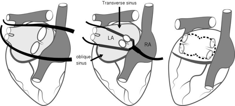 A fib : TTA (Totally Thoracoscopic Ablation) 와 Maze OP : 네이버 블로그