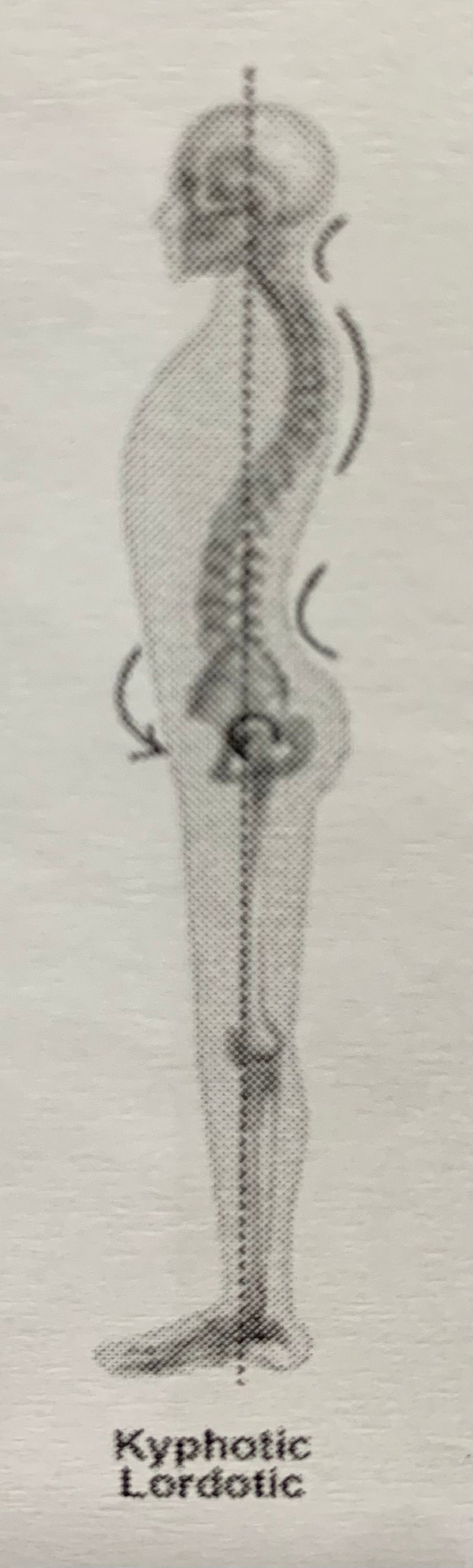 Kendal의 체형불균형-Kyphotic-Lordotic posture 울산피티 울산삼산피티 달동피티 신정동피티 옥동피티 ...