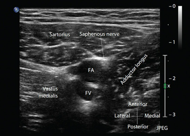 US guided adductor canal block의 해부학적 고찰 : 네이버 블로그