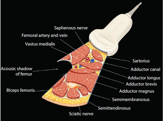 US guided adductor canal block의 해부학적 고찰 : 네이버 블로그