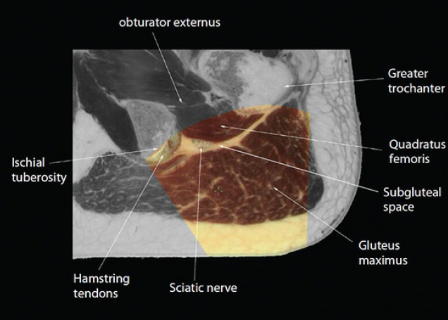 US guided sciatic nerve block의 해부학적 고찰 : 네이버 블로그