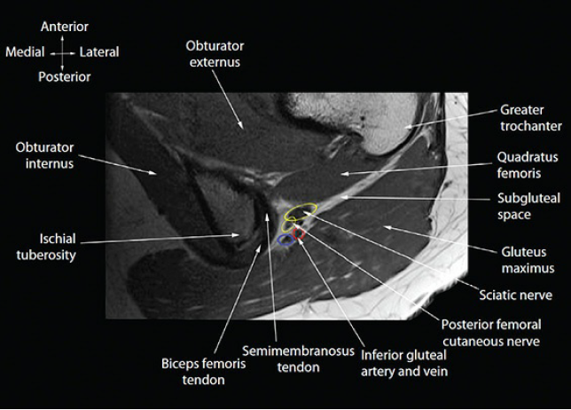 US guided sciatic nerve block의 해부학적 고찰 : 네이버 블로그