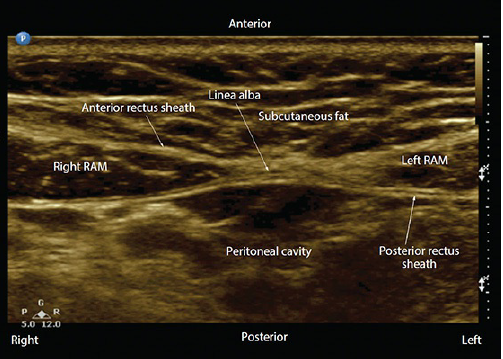 US guided rectus sheath block : 네이버 블로그