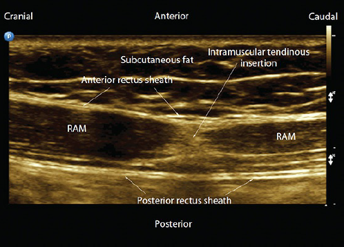 US guided rectus sheath block : 네이버 블로그