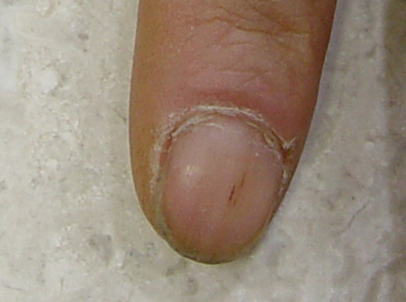 외상에 의한 손발톱선상출혈(Splinter hemorrhage)과 손발톱밑출혈(Subungual hemorrhage) : 네이버 블로그