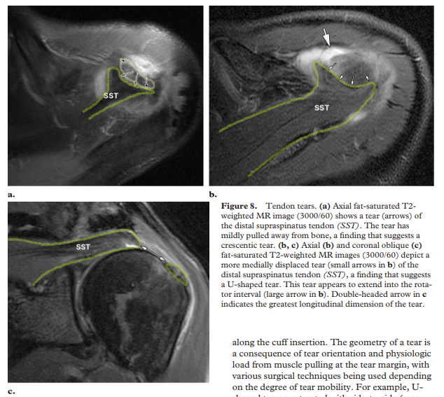 어깨 MRI 보는 법에 대해 공부해봅니다(1) : 네이버 블로그
