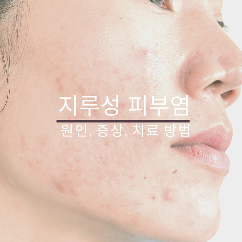 지루성 피부염에 관한 모든 것 원인 증상 치료방법 네이버 블로그