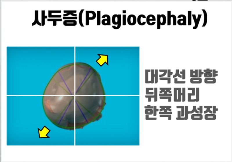 아기사두증에 대해 한번 자세히 알아볼까요사두증 두개골유합증 두상교정 두상스캔 네이버 블로그