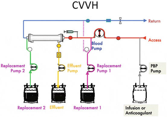 [간호심화 : CRRT]지속적 신대체 요법(Continuous Renal Replacement Therapy, CRRT ...